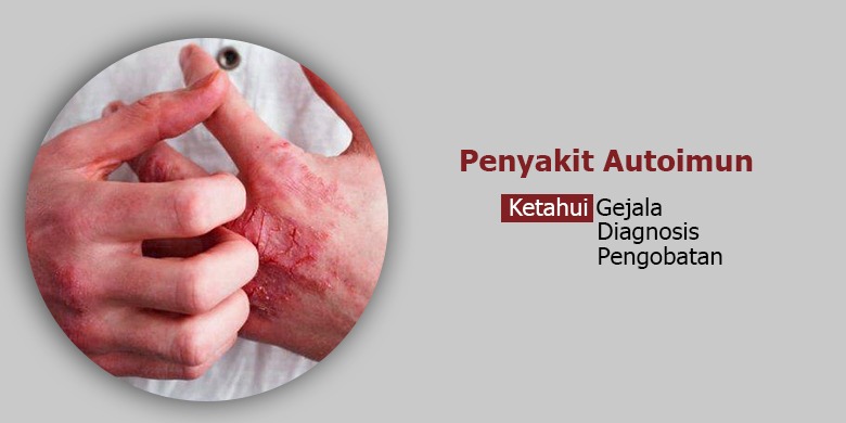 Menghadapi Autoimun: 3 Strategi Dan Tips Menghadapi Penyakit